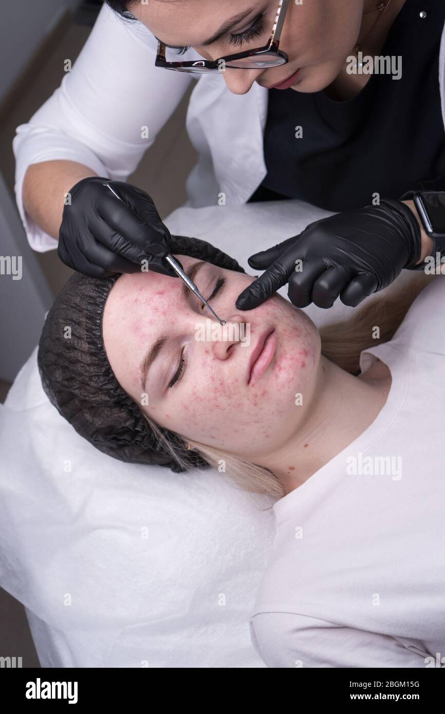 Procedure mechanical face cleaning in beauty salon. Young model getting ...