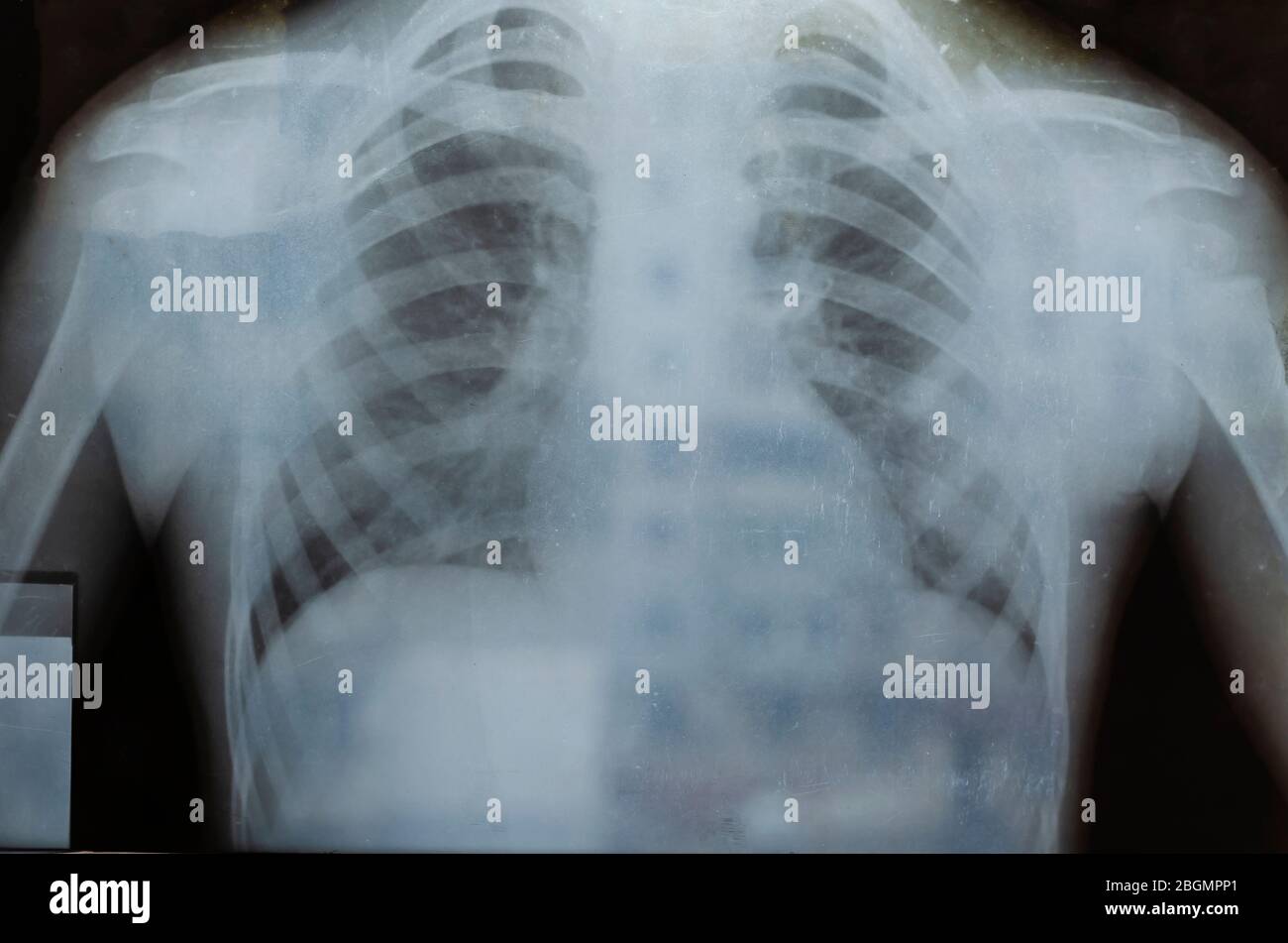 Chest x ray of child hi-res stock photography and images - Alamy