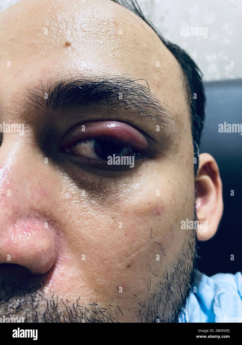 A stye or sty (hordeolum) is a red bump, sort of like a pimple, that ...