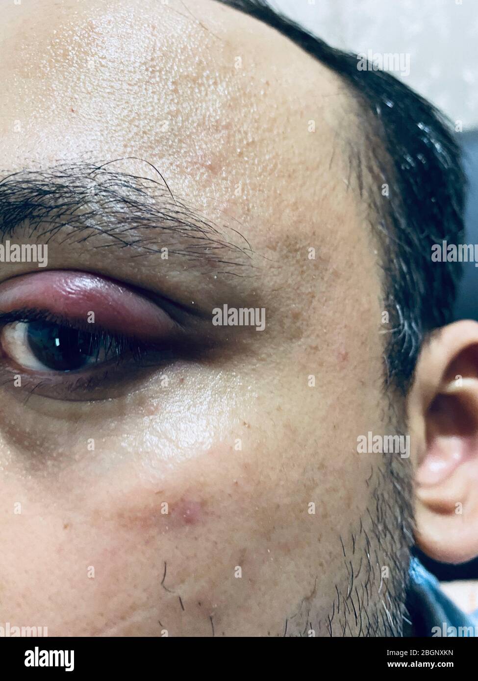 A stye or sty (hordeolum) is a red bump, sort of like a pimple, that ...