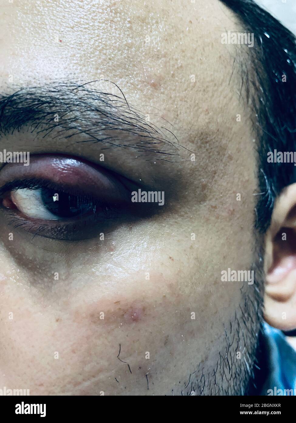 Bruised eyelid hi-res stock photography and images - Alamy