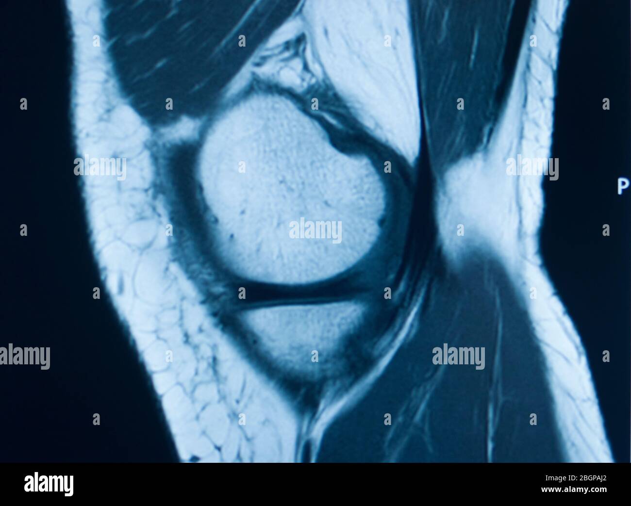Knee sports injury mri mcl grade 2 tear magnetic resonance imaging ...