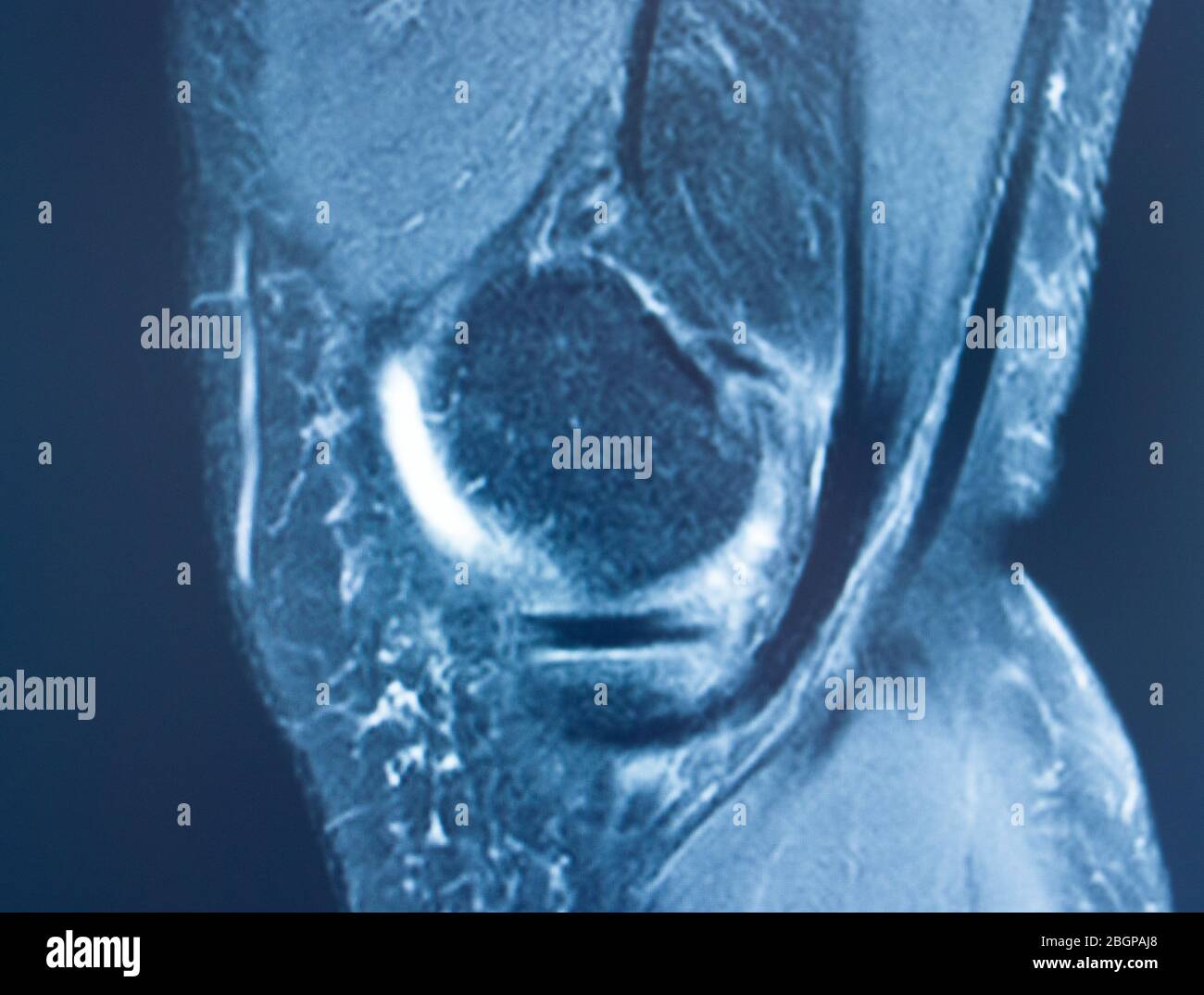 Knee sports injury mri mcl grade 2 tear magnetic resonance imaging ...