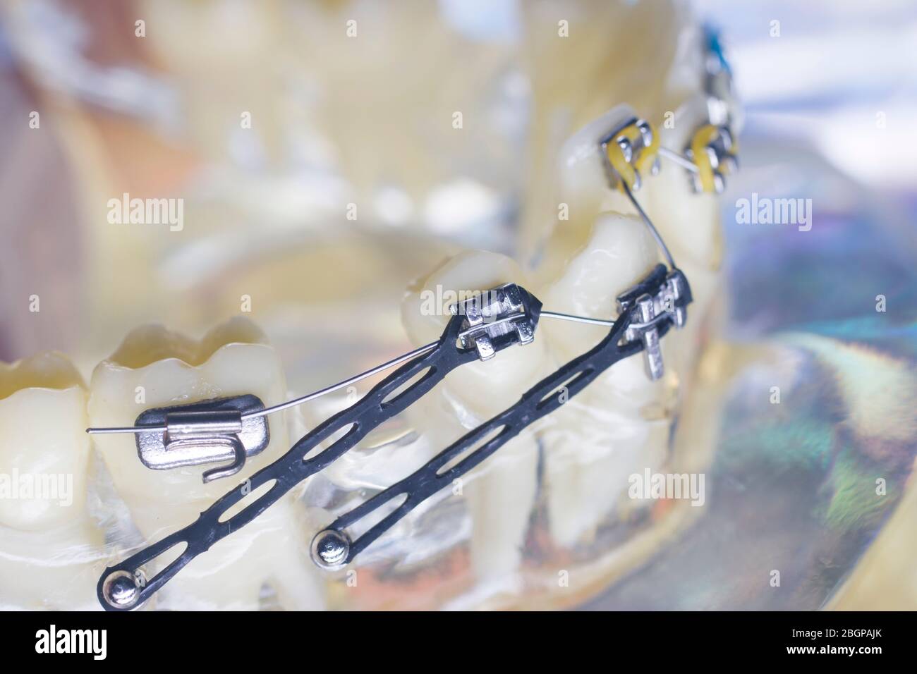 Modern metal retainers and plastic algners wire dental brackets teeth ...