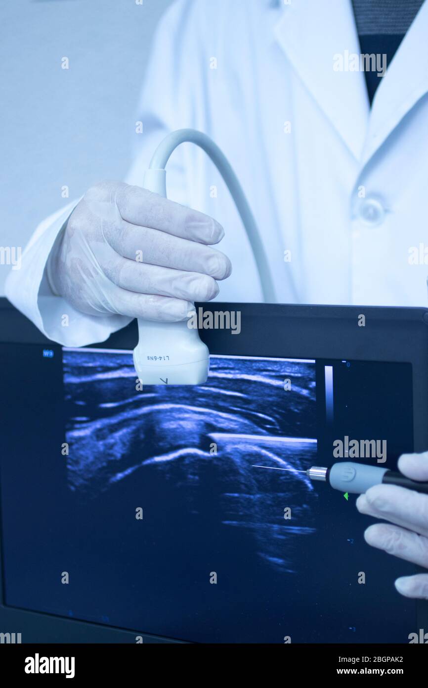 EPI Intratissue Percutaneous Electrolysis dry needling ultrasound ...