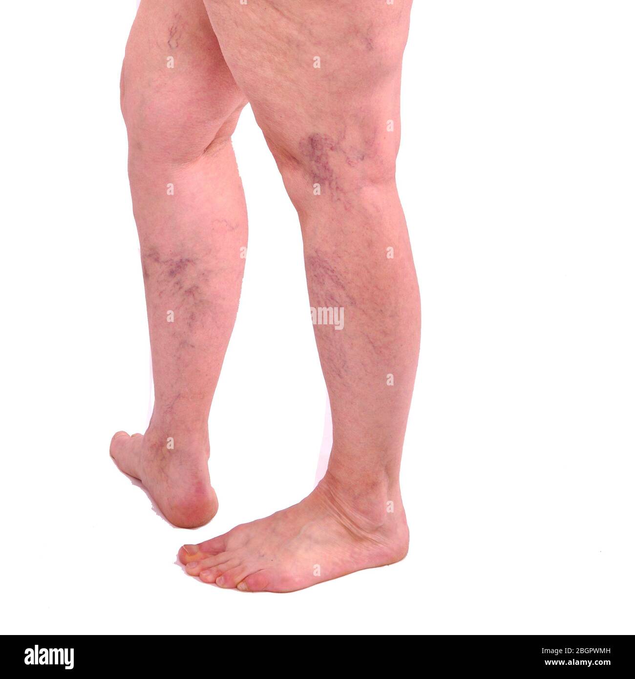 Female legs with varicose veins and leg spiders. The concept of human ...