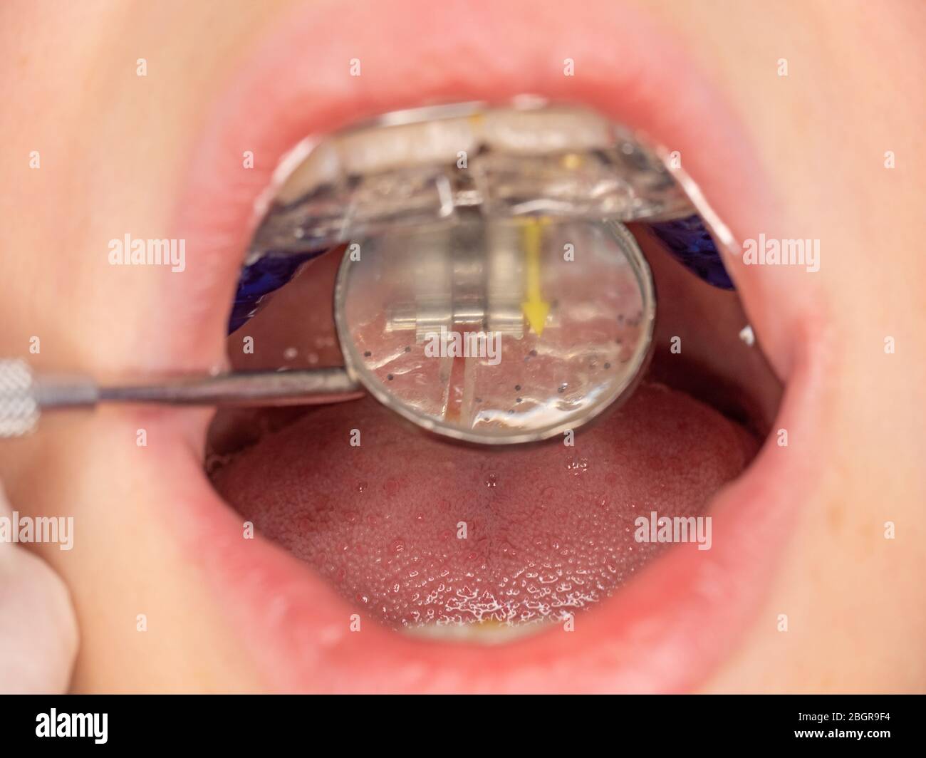 Palatal expander hi-res stock photography and images - Alamy