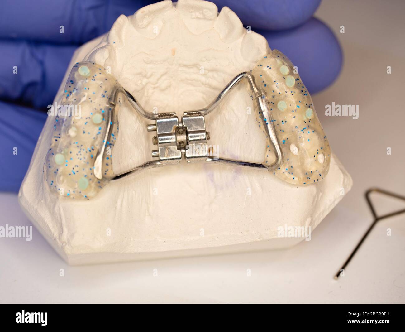 Hyrax braces wear on patient teeth gypsum model. Dentist check exact ...