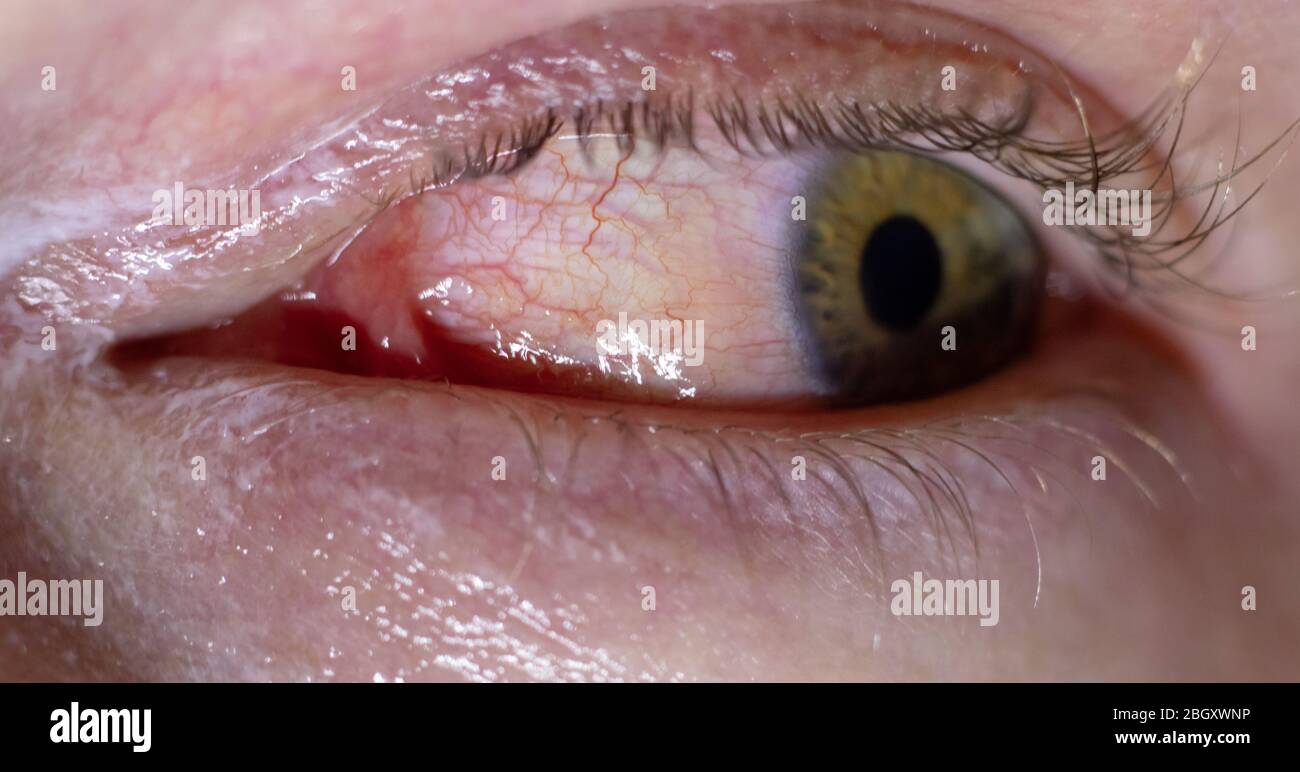 Inflamated eye infection. Red bloody eye closeup macro result of ...