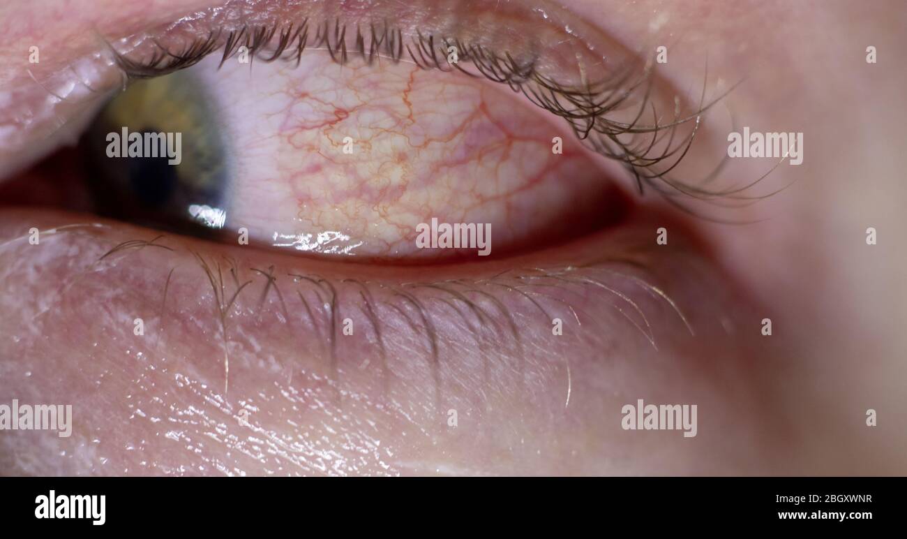 Eye infection hi-res stock photography and images - Alamy