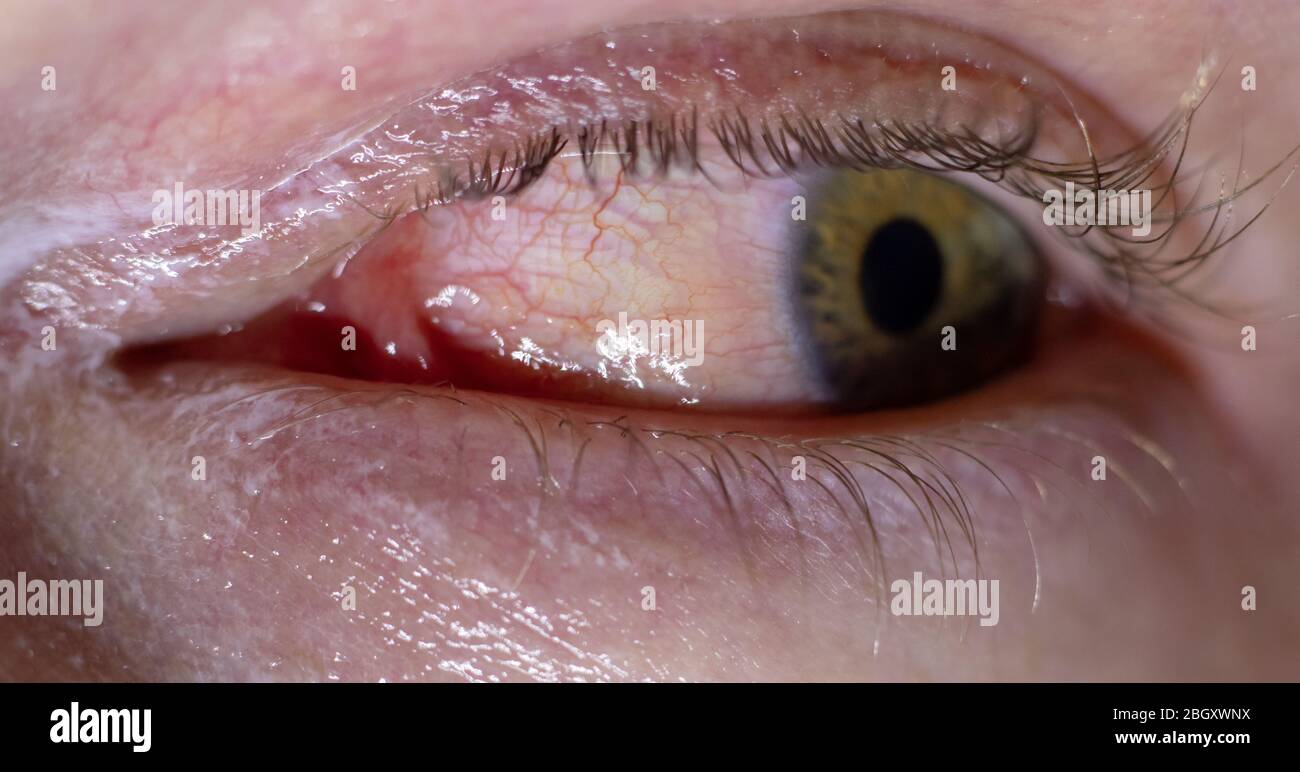 Inflamated eye infection. Red bloody eye closeup macro result of ...