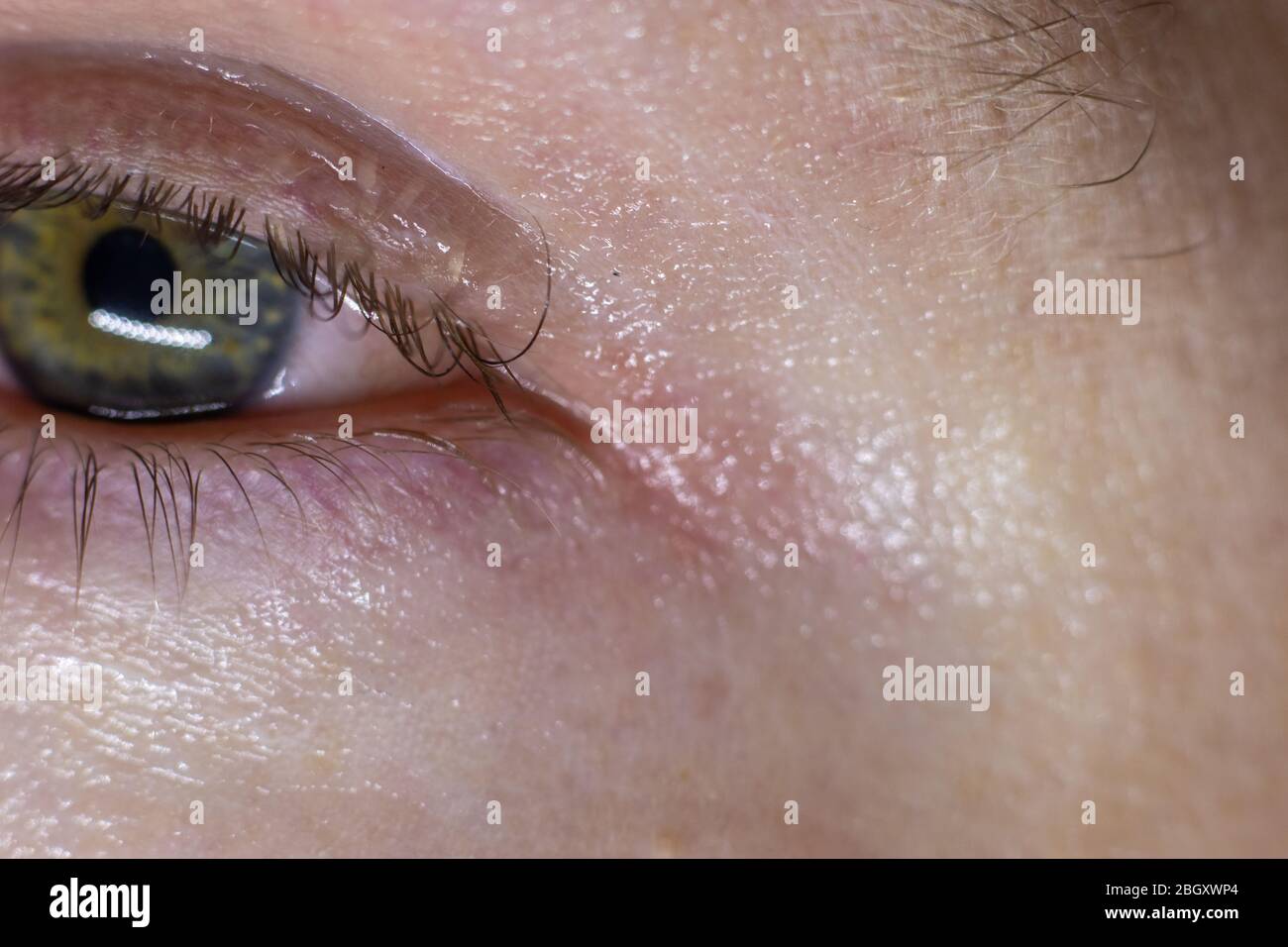 Inflamated eye infection. Red bloody eye closeup macro result of ...