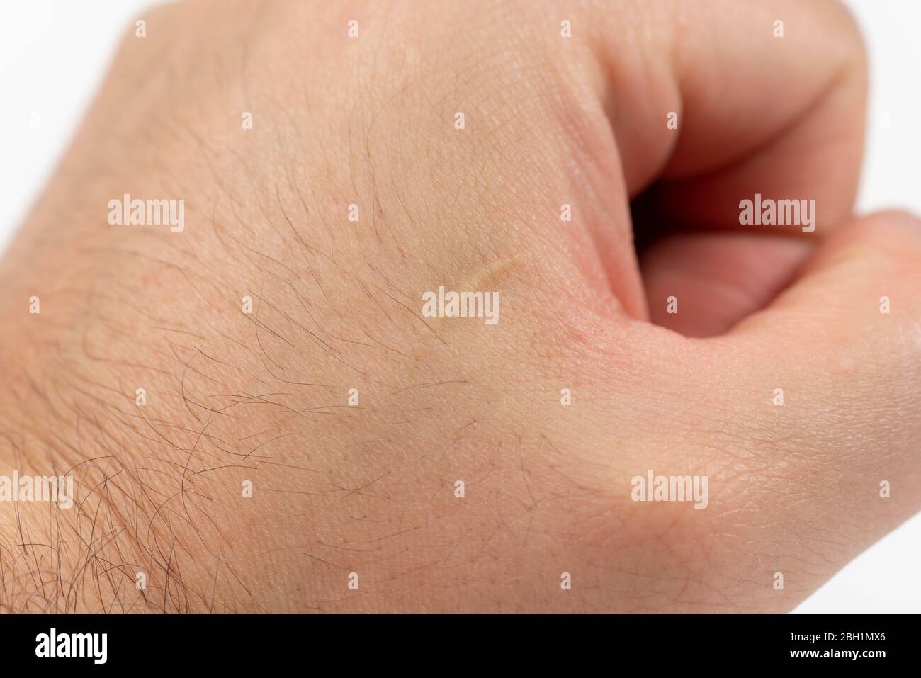 Burn scar hand hi-res stock photography and images - Alamy