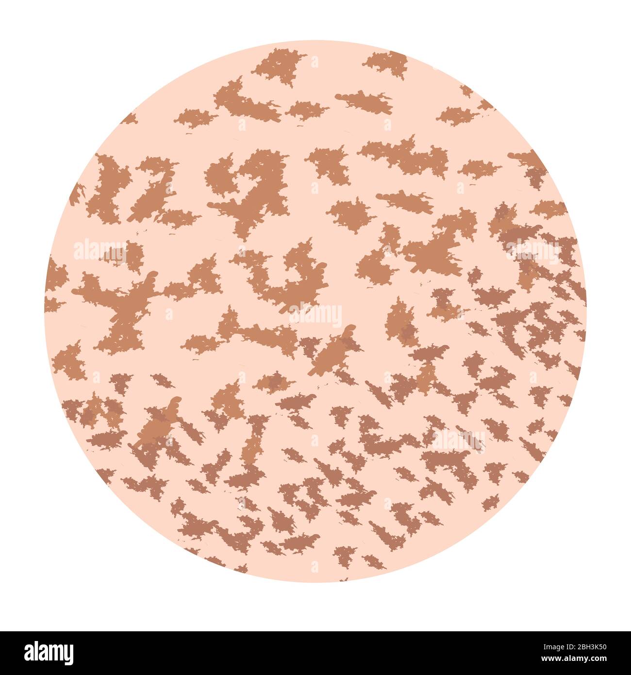 Pigmentation on the skin. A pigmented spot on the skin of the face ...