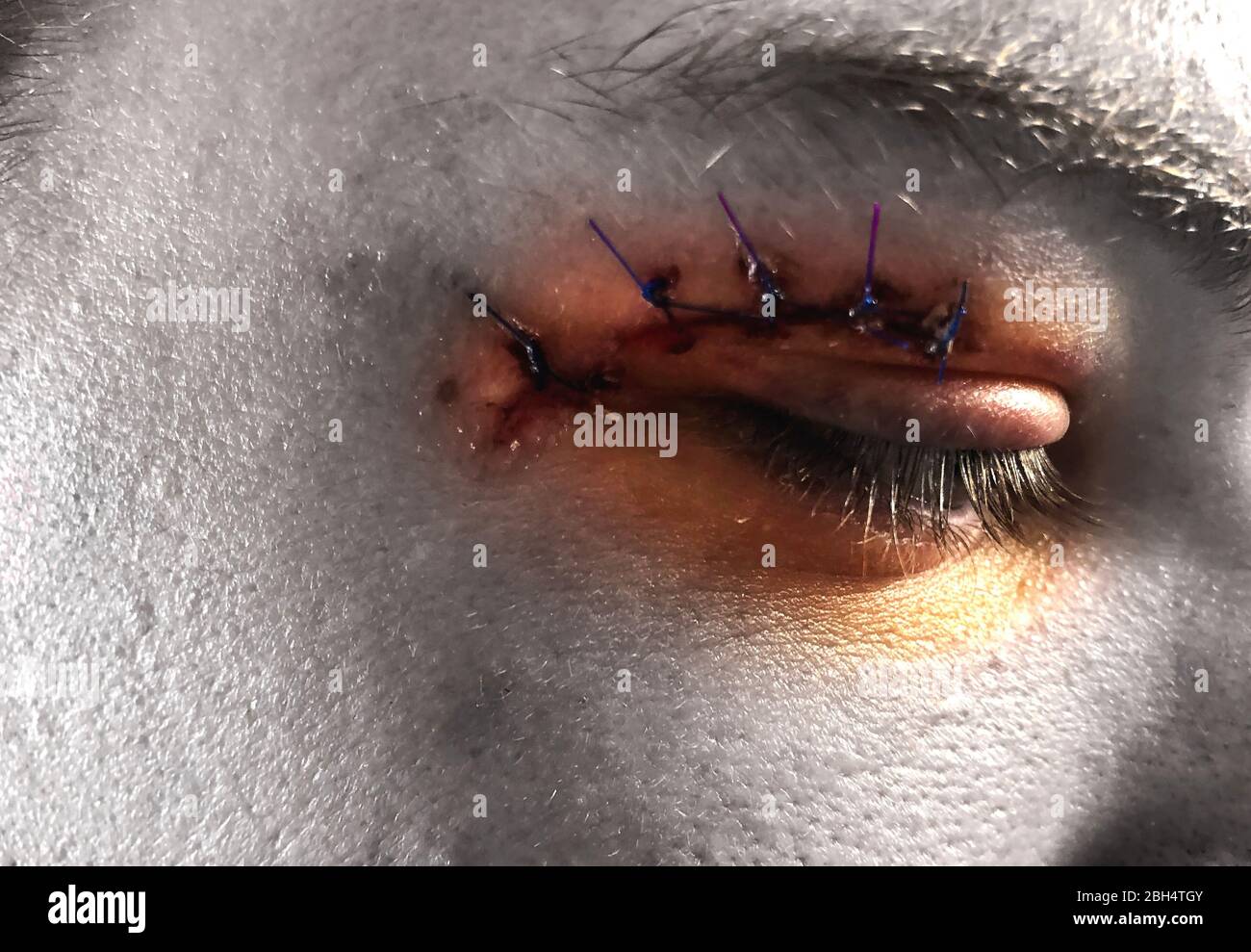 Eyelid swelling hi-res stock photography and images - Alamy