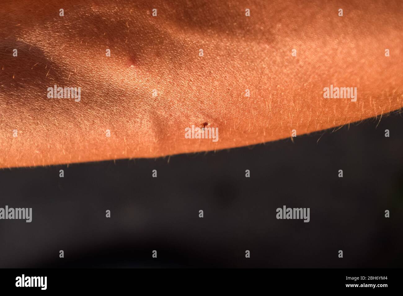 Bee sting skin hi-res stock photography and images - Alamy