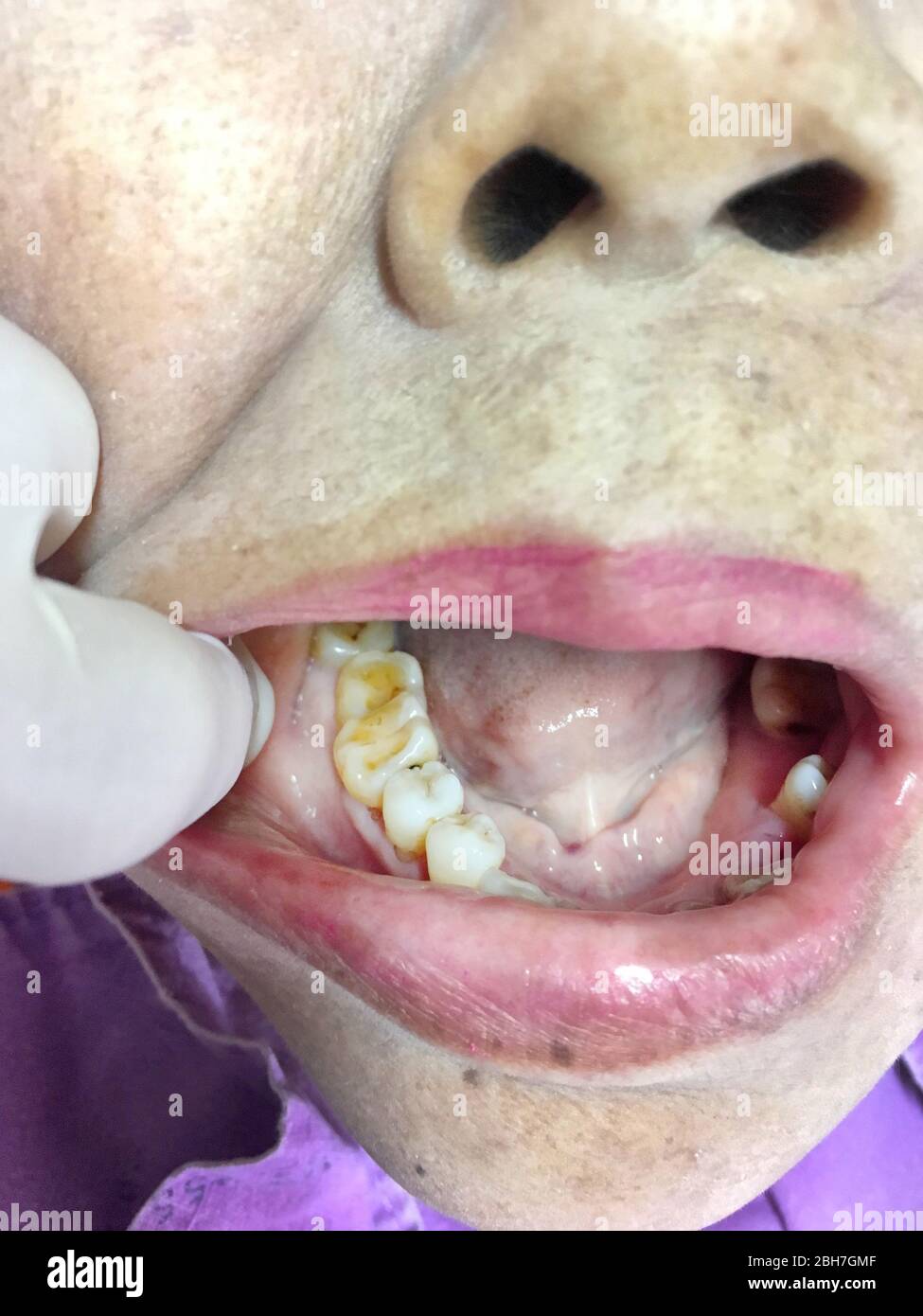 Decayed Teeth High Resolution Stock Photography and Images - Alamy