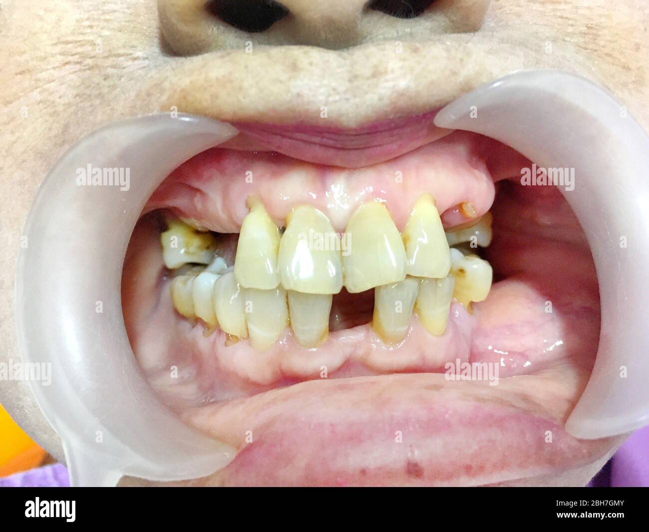 he Decayed teeth in the women mouth with dentist hand Stock Photo - Alamy