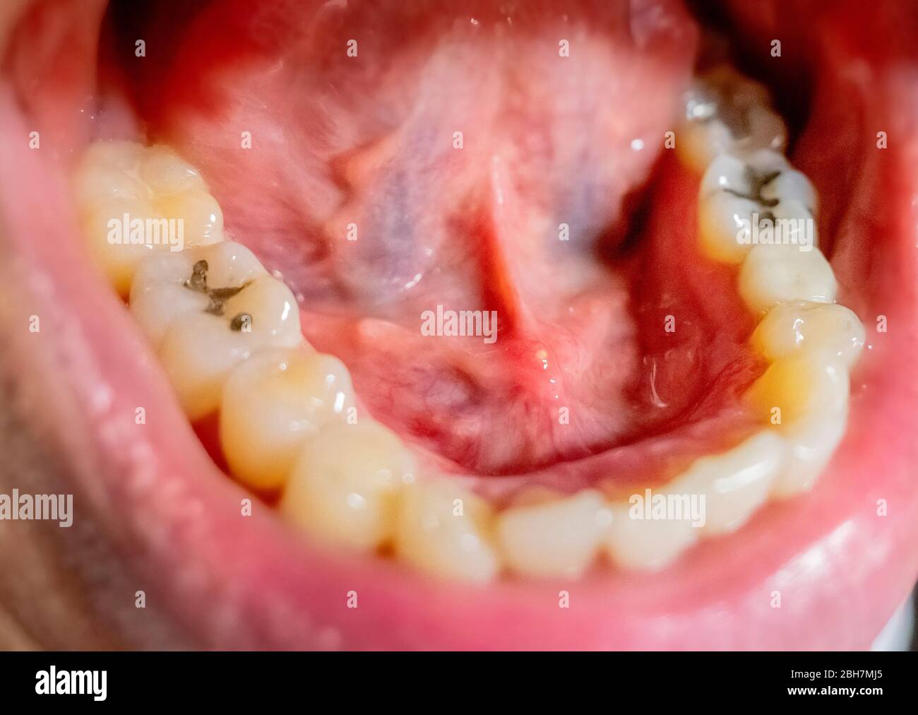 Sublingual Gland Cyst