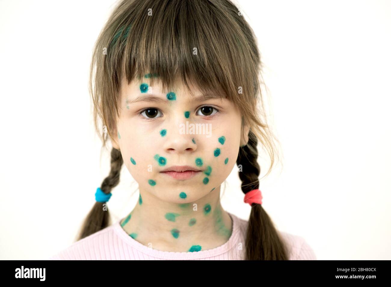 Child girl covered with green rashes on face ill with chickenpox ...