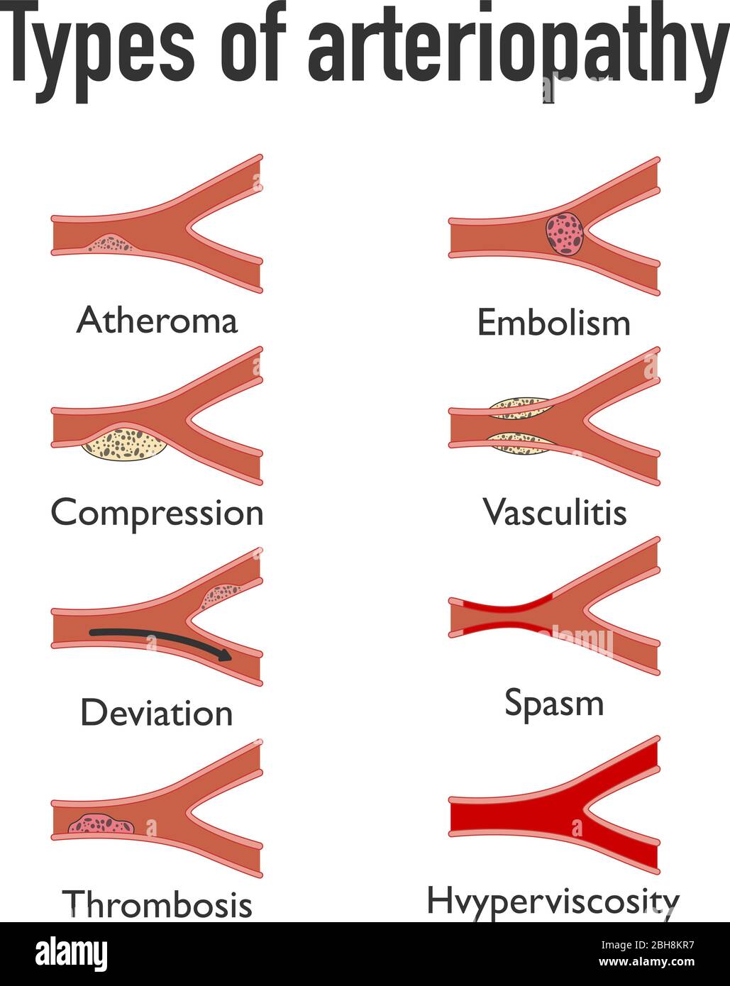 Types of arteriopathy, set of arteries atheroma, embolism, compression ...