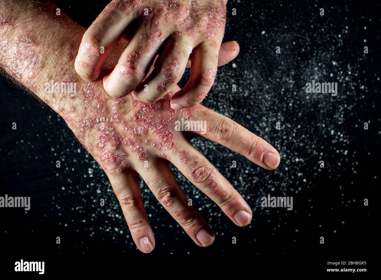 Psoriasis (eczema) on the hand Man itching skin Psoriasis scales are ...