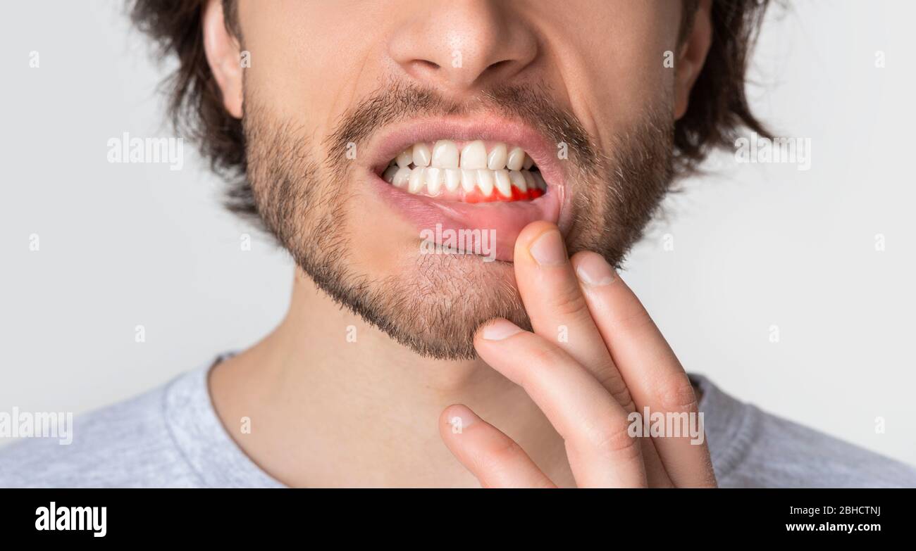 Tooth decay hi-res stock photography and images - Alamy