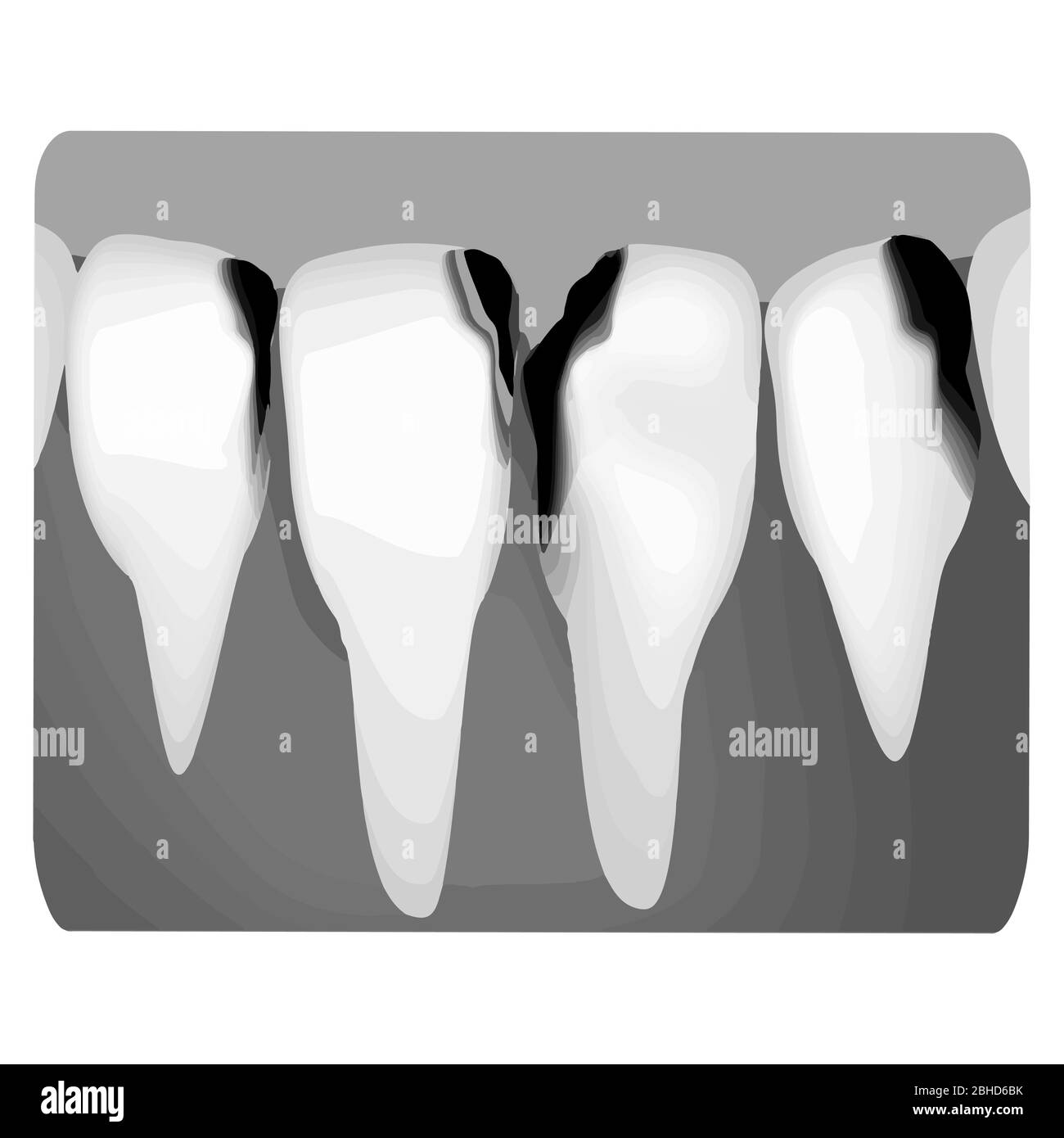 Dental caries. X-ray of tooth decay. Caries infographics. Vector ...
