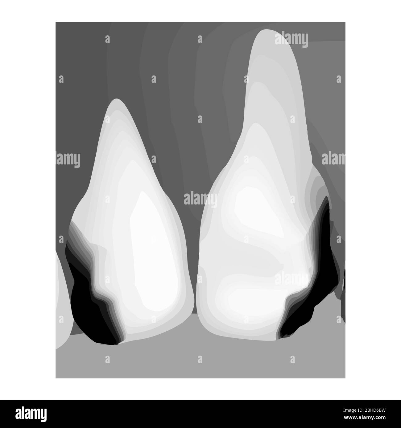 Dental caries. X-ray of tooth decay. Caries infographics. Vector ...