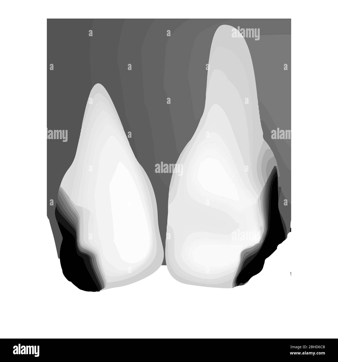 Dental caries. X-ray of tooth decay. Caries infographics. Vector ...