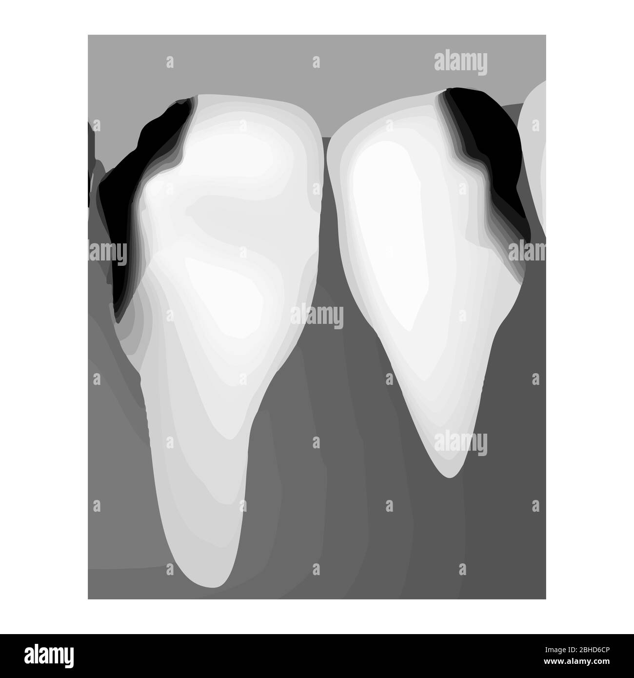Dental caries. X-ray of tooth decay. Caries infographics. Vector ...