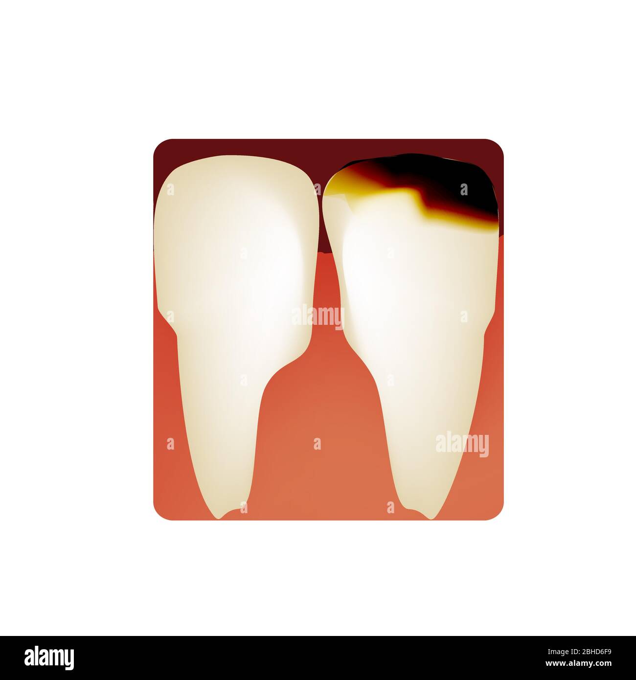 Dental caries. tooth decay. Caries infographics. Vector illustration on ...
