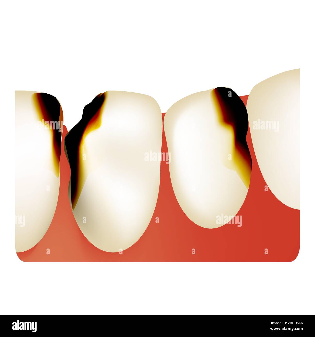 Dental caries. tooth decay. Caries infographics. Vector illustration on ...