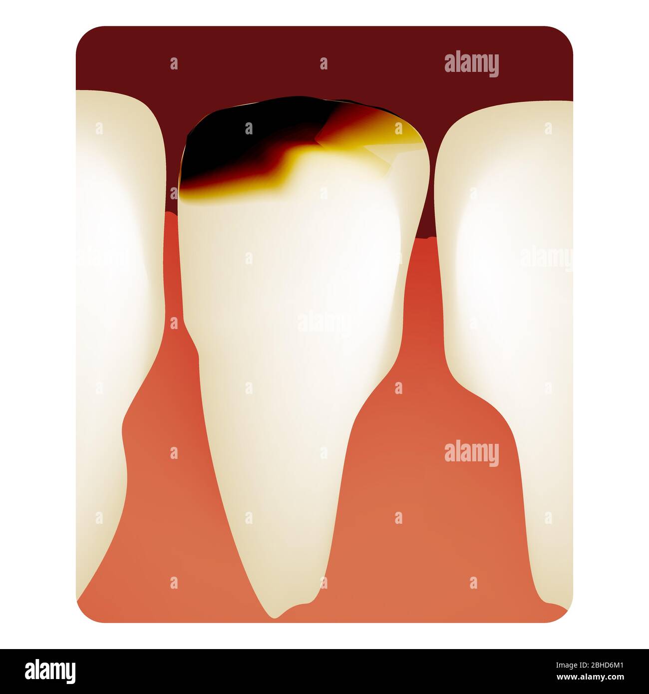 Dental caries. tooth decay. Caries infographics. Vector illustration on ...