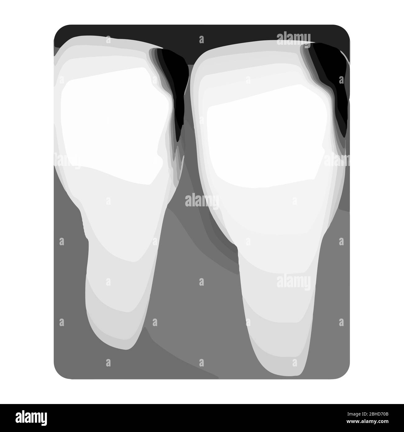 Dental caries. X-ray of tooth decay. Caries infographics. Vector ...
