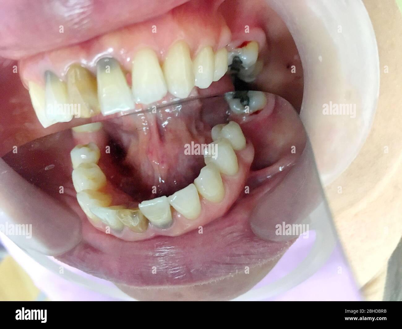 Photo of Discoloration teeth on patient's mouth with mouth gag and ...