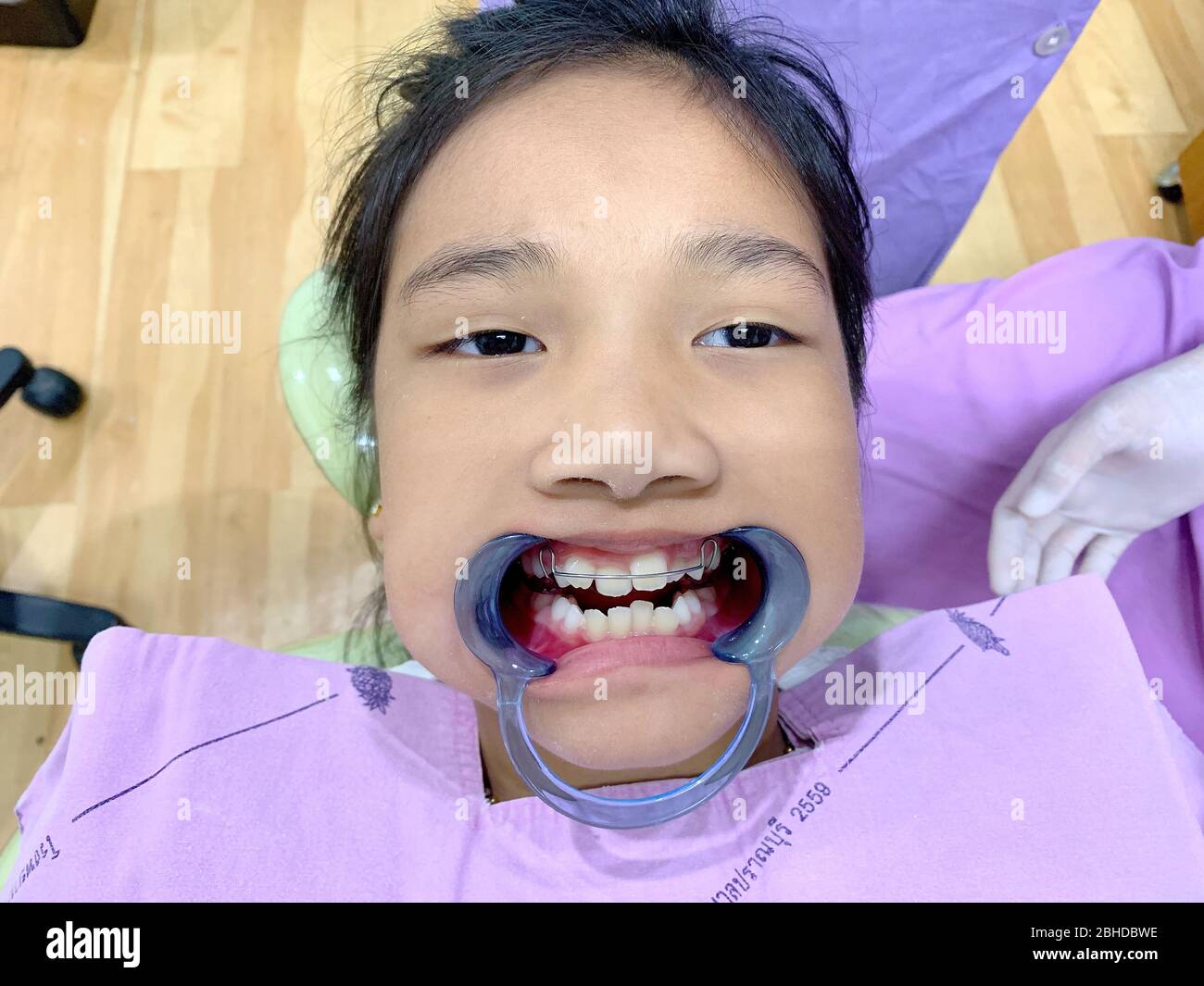 The Asian girl open her mouth with mouth gag and show removable ...