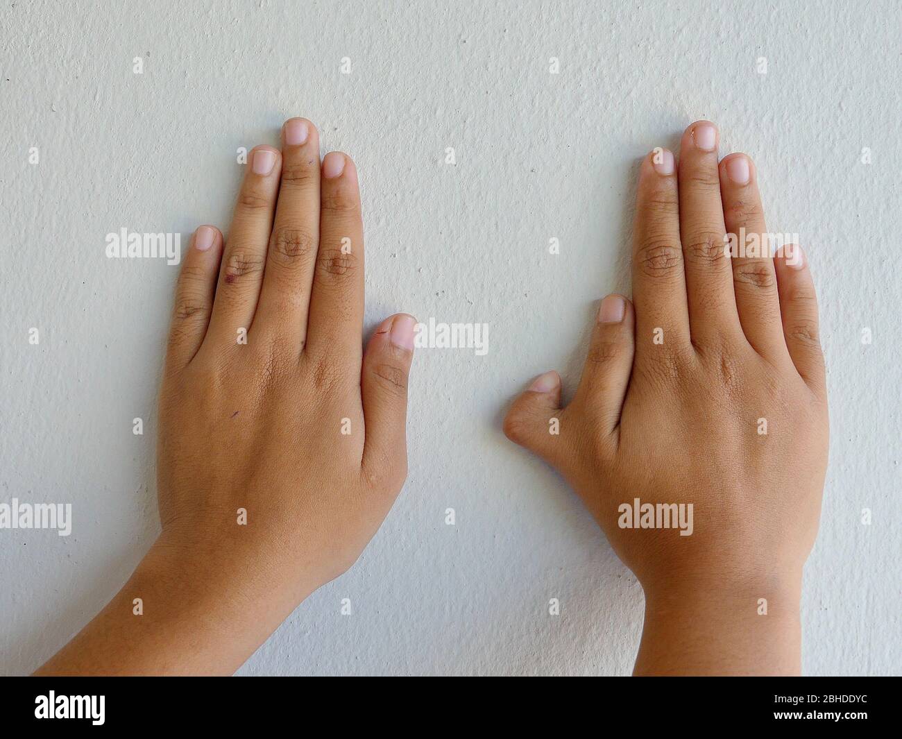 Congenital deformity of the hands hi-res stock photography and images ...