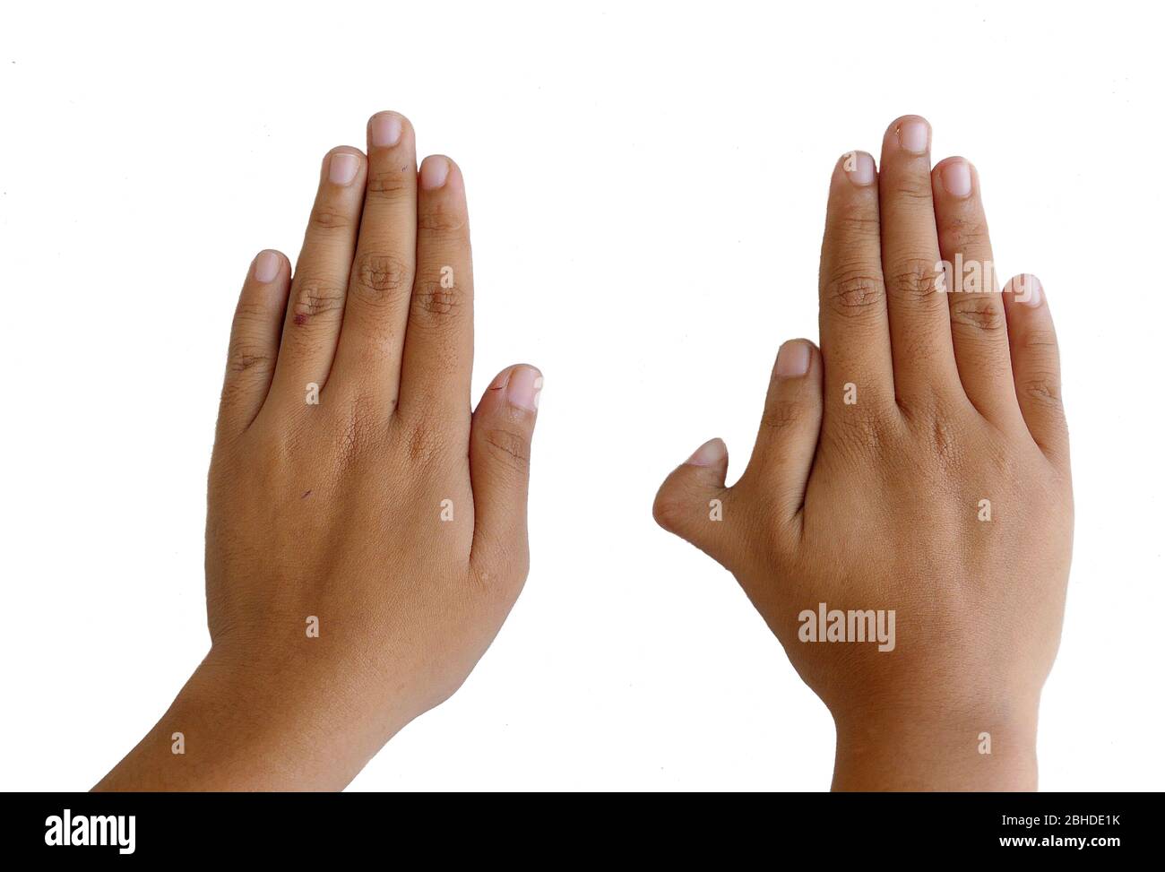 Photo of Polydactyly on human; rare abnormal characteristic causes by ...