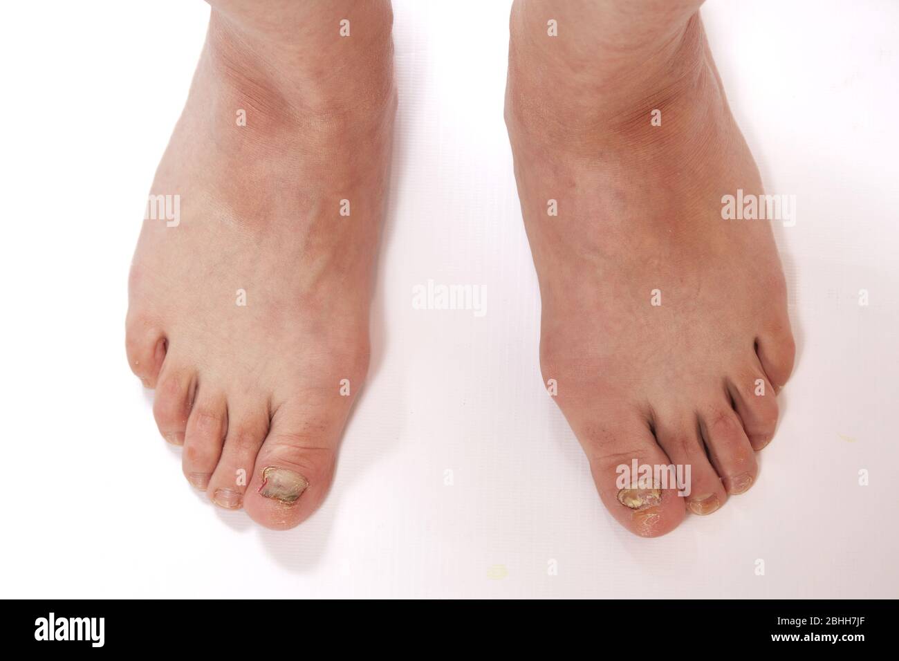 women's legs. fingers close-up with nails affected by fungal nail ...