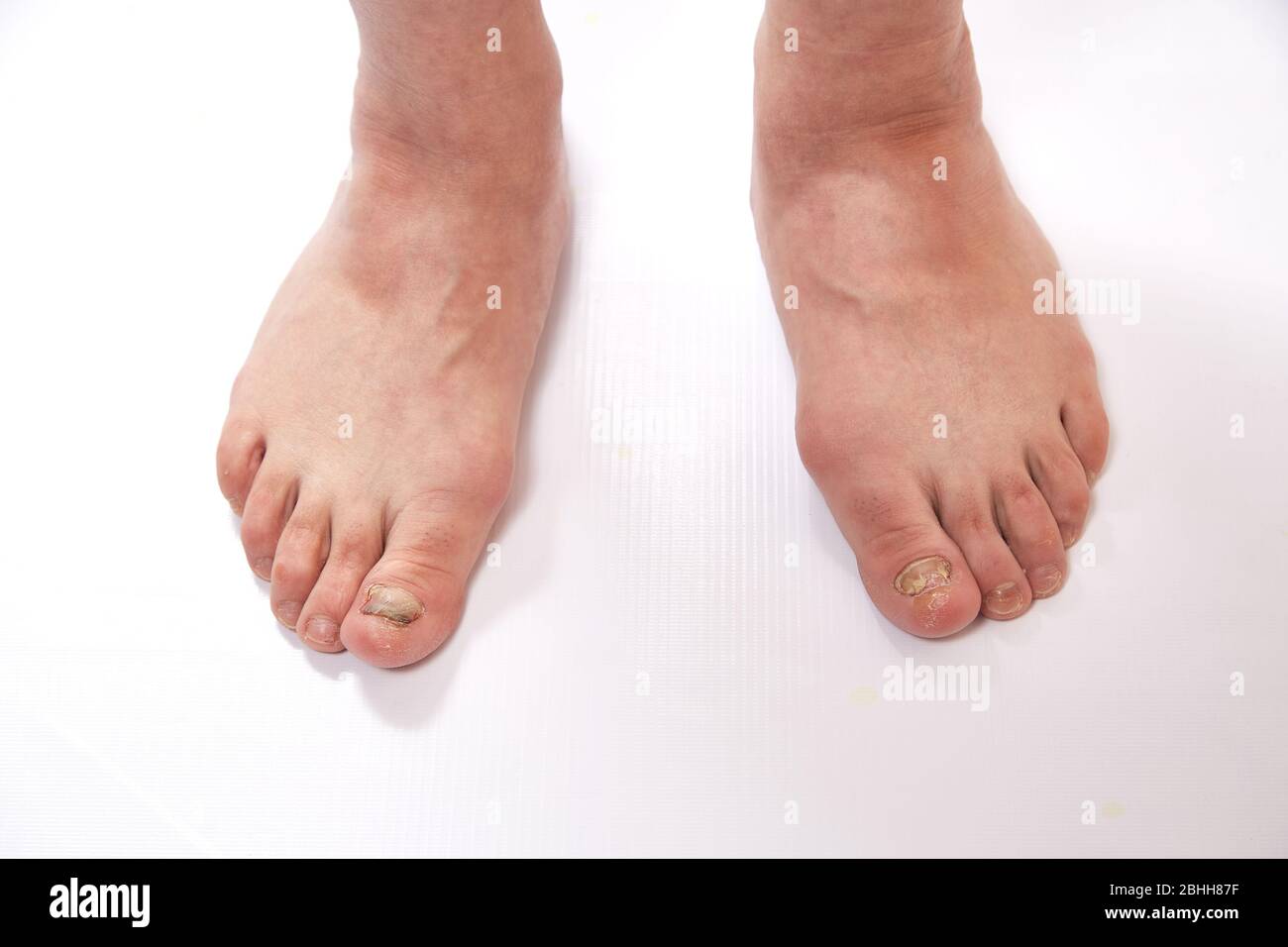 women's legs. fingers close-up with nails affected by fungal nail ...