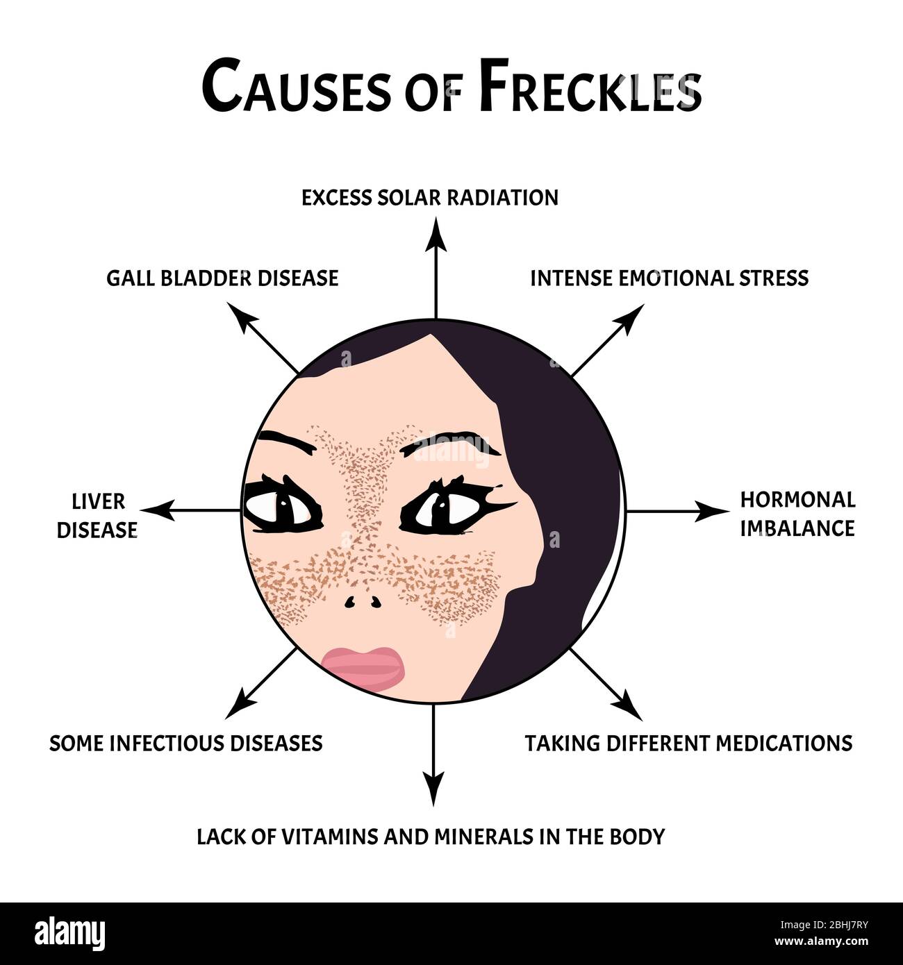 Freckles on the face of the cause. Pigmentation on the skin. A ...
