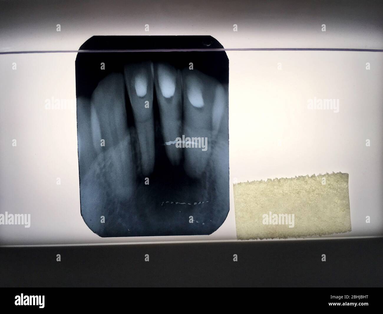 Photo of The X-ray film of teeth diagnosed in the dental clinic of ...