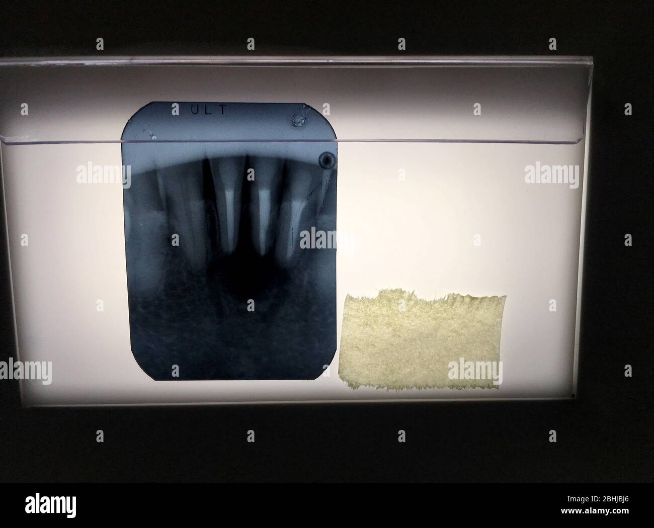 Photo of The X-ray film of teeth diagnosed in the dental clinic of ...