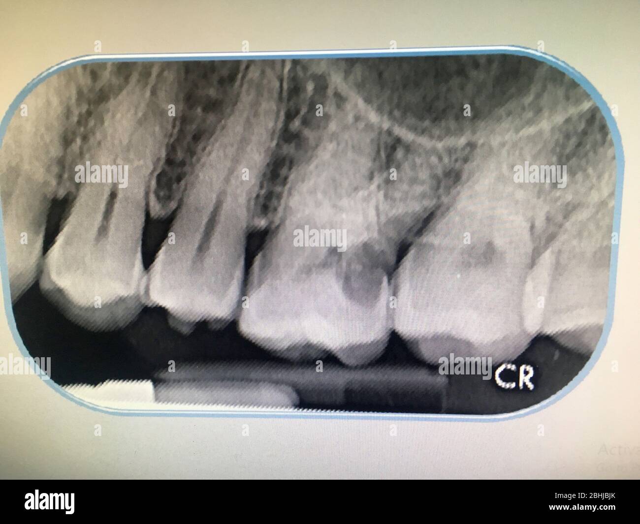 Photo of The X-ray film of teeth diagnosed in the dental clinic of ...