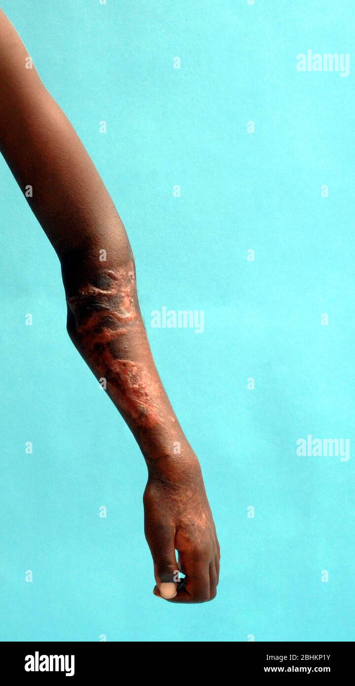 An ischaemic arm of a young teenage boy. Ischaemia is a restriction in ...