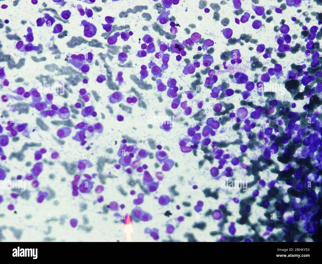 Multiple myeloma plasma cells hi-res stock photography and images - Alamy