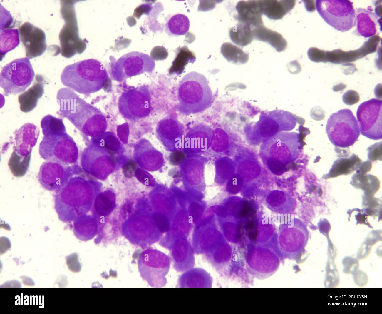Multiple myeloma plasma cells hi-res stock photography and images - Alamy