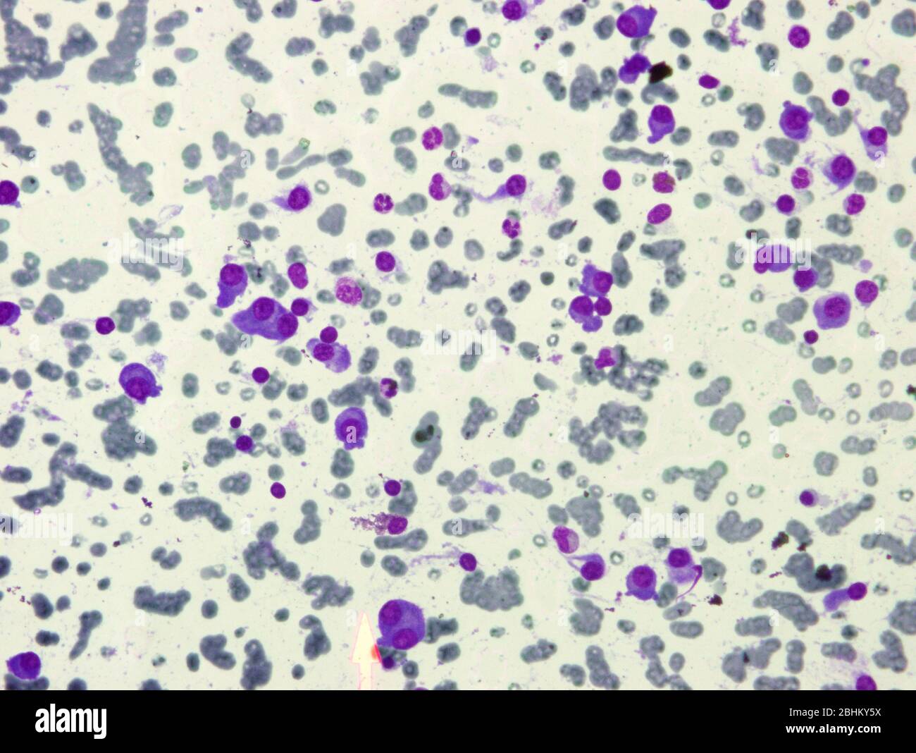 Multiple myeloma cells hi-res stock photography and images - Alamy