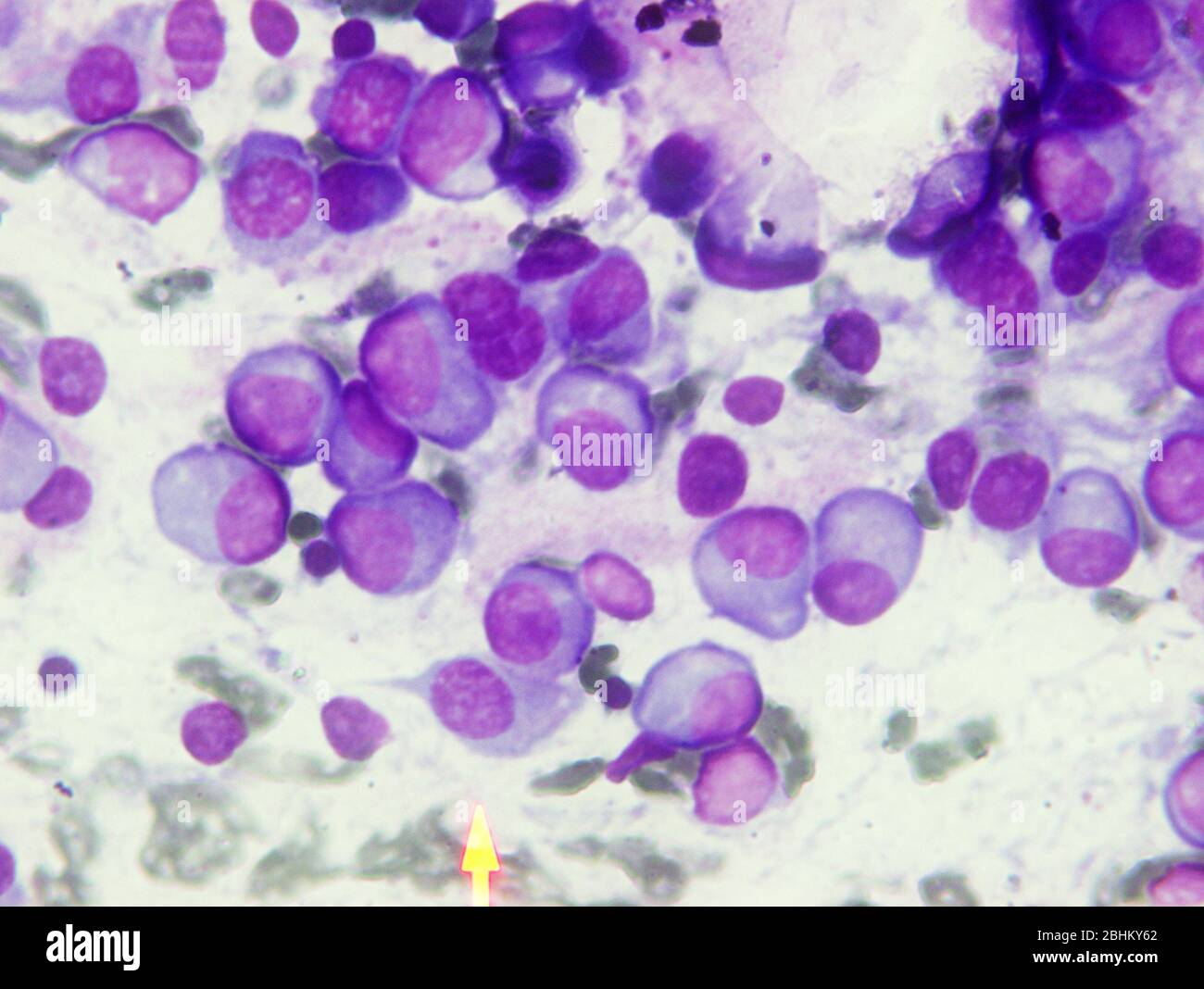 Plasma Cells In Bone Marrow